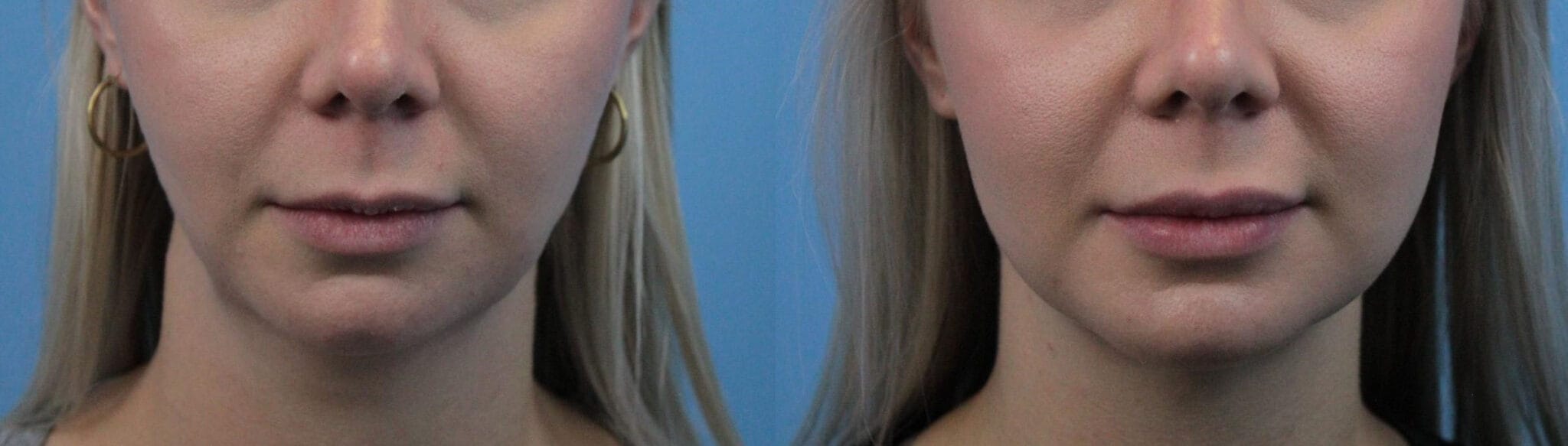 Cheek-Liposuktion - Look Younger Clinic